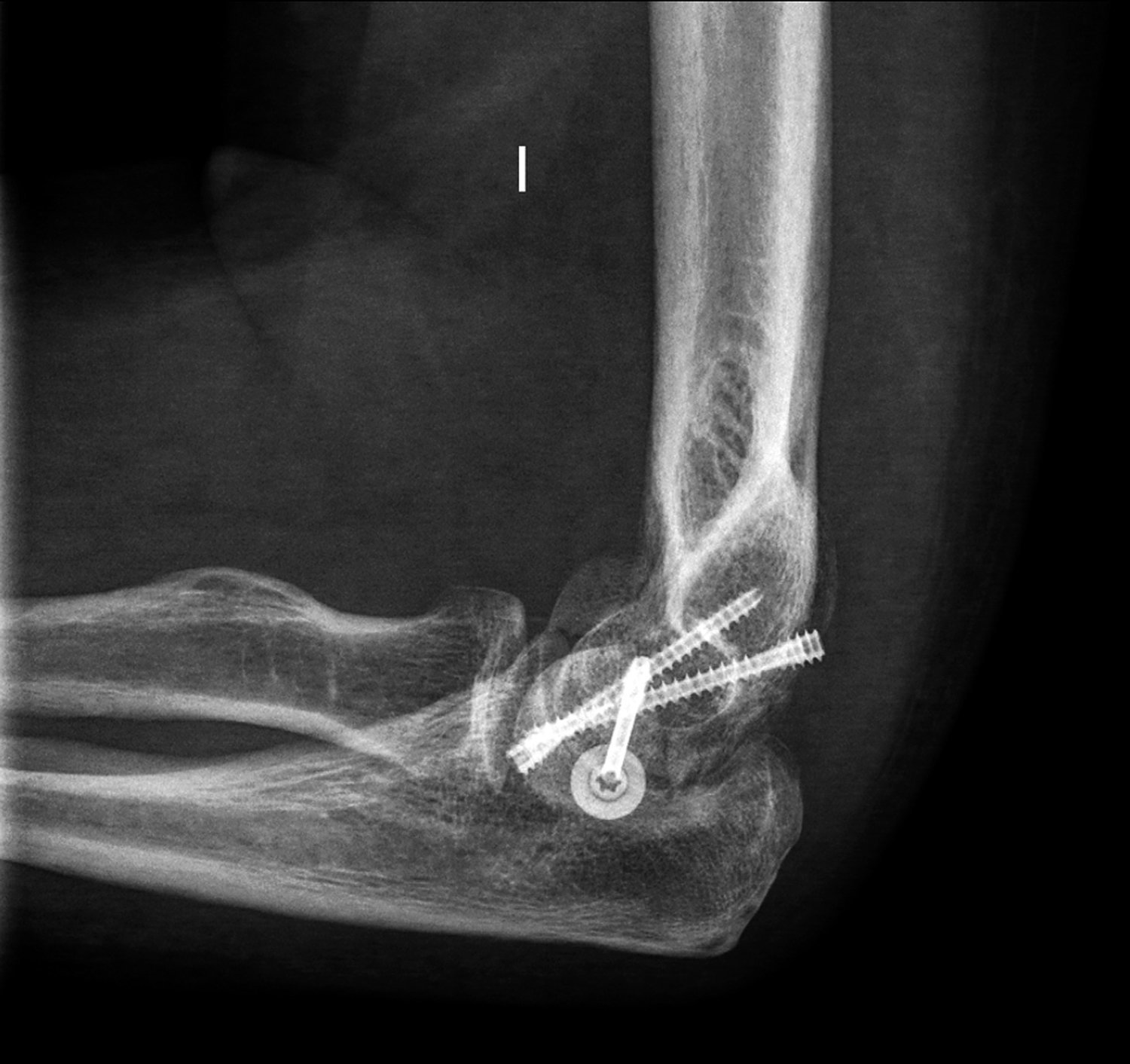 David Valdés | recomposición húmero distal | Sedition